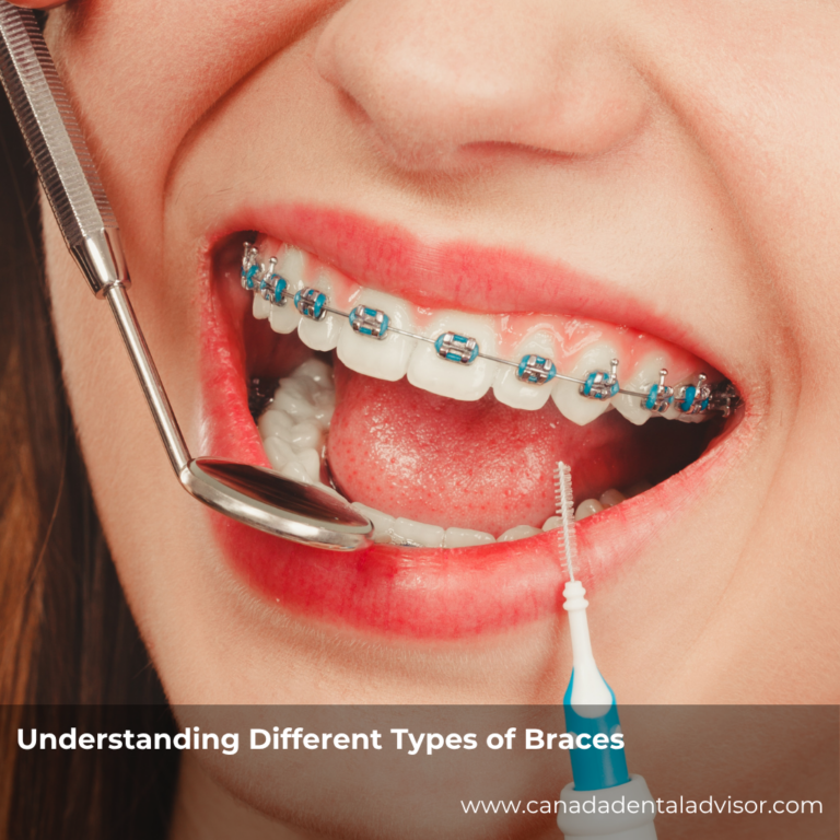Understanding Different Types of Braces
